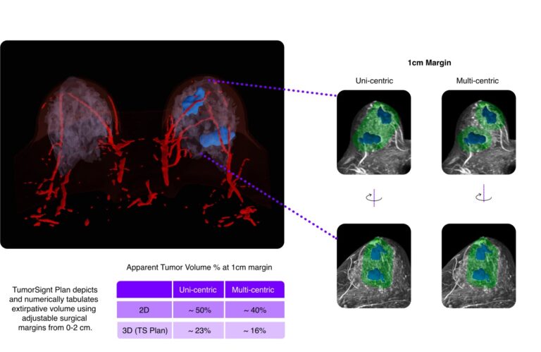 TUMORSIGHT VIZ – SimBioSys
